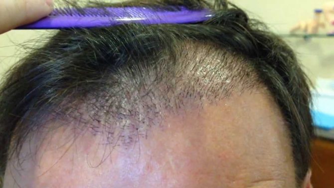 Efluvio telógeno, causa muy común en la caída del pelo